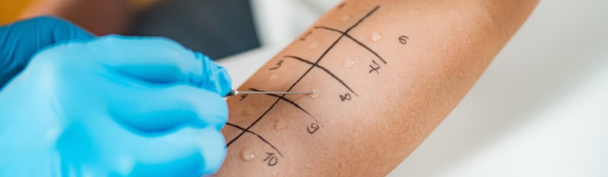 Teste alérgico: o que é, como é realizado e quando é indicado • UMC